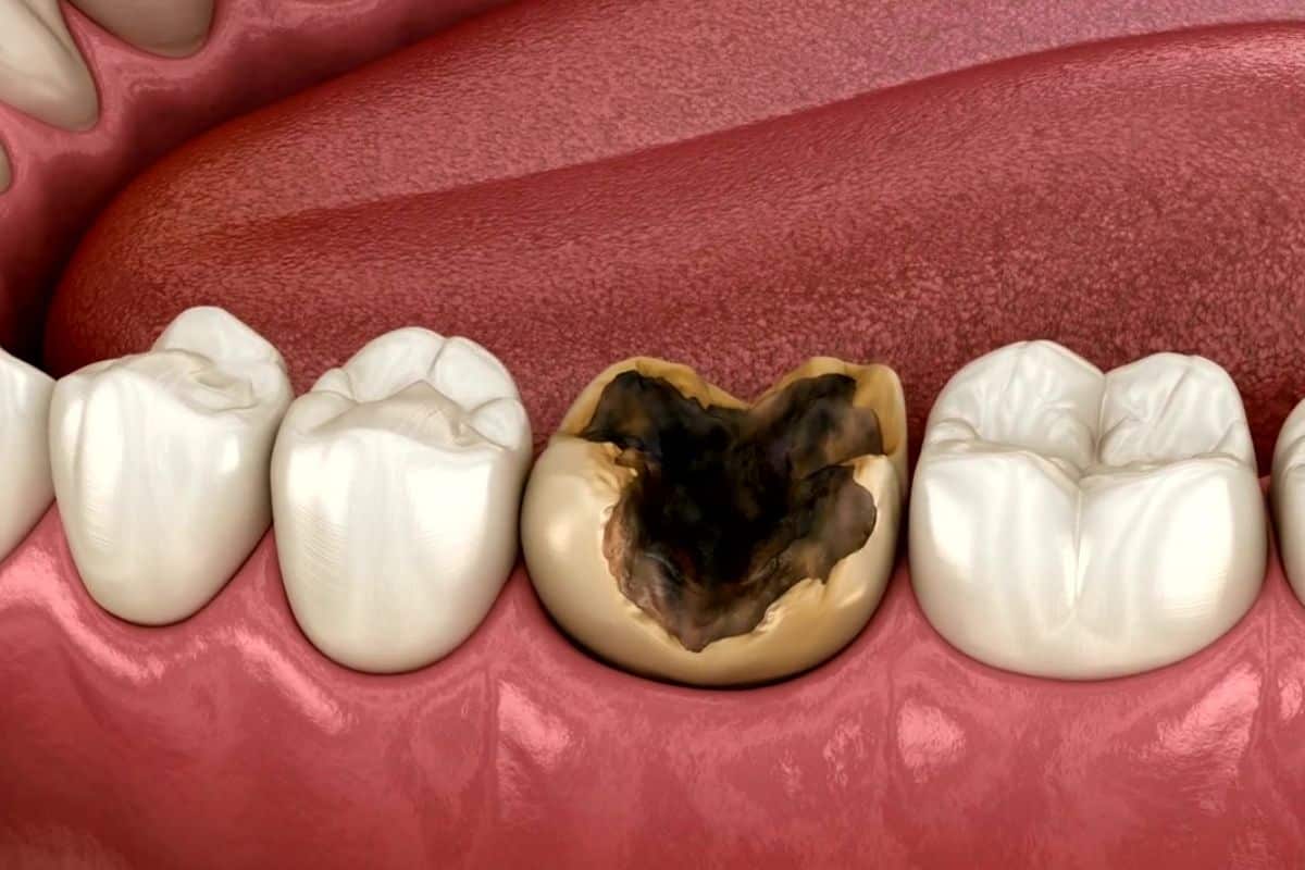 Stay Cavity Free in 2025: Simple Daily Steps for Better Oral Health