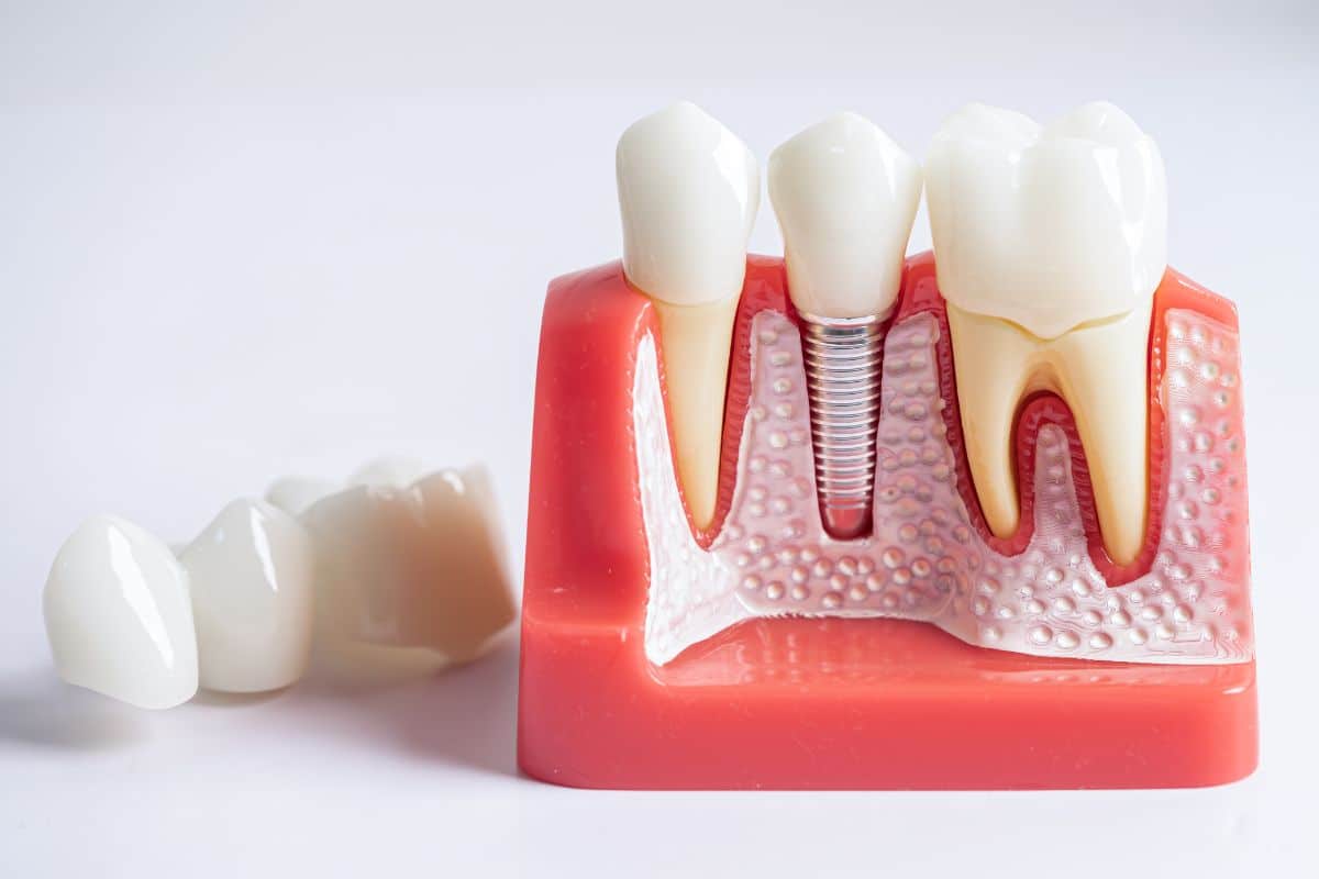 Dental Implants and Gum Disease: How Oral Health Affects Implant Success