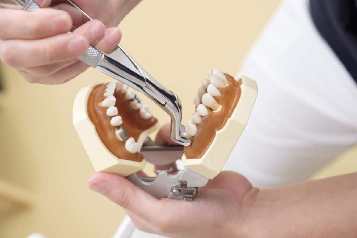 How Many Teeth Can Be Extracted at One Sitting?